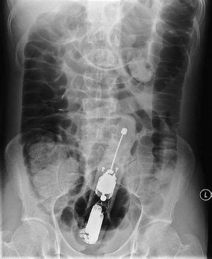 Foreign Body In Rectum Medizzy