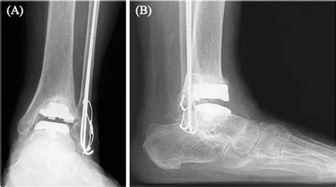 Figure 1 From Ten Year Follow Up Of A Customized Total Talar Prosthesis