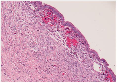 Ovarian Endometrioma Sections Stained With Hematoxylin And Eosin ×200