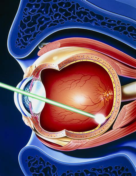 Detached Retina Surgery