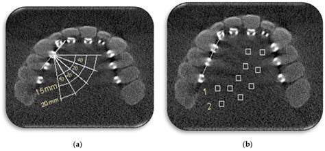 A Quantitative Evaluation Of The Effectiveness Of The Metal Artifact Reduction Algorithm In Cone