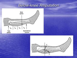 Amputations And Disarticulations In Limbs Ppt