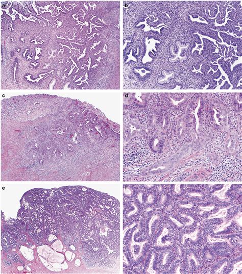 Endocervical Adenocarcinoma Selected Diagnostic Challenges Modern