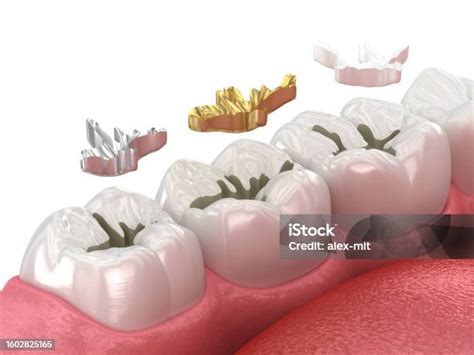 치과 용 충전재 세라믹 황금 금속 치과 3d 그림 이빨에 대한 스톡 사진 및 기타 이미지 이빨 치아 보충재 금 금속 Istock