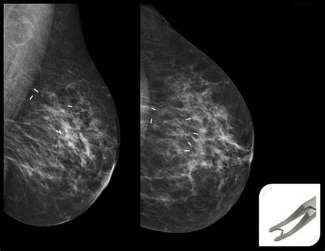 Surgical Clips Mammogram Shows Linear Radiopaque Clips Placed During