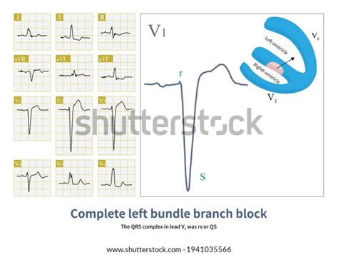 During Complete Left Bundle Branch Block Stock Illustration 1941035566 Shutterstock