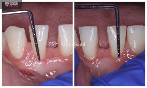 Partial Root Coverage For Miller Class Iii Gingival Recession Of