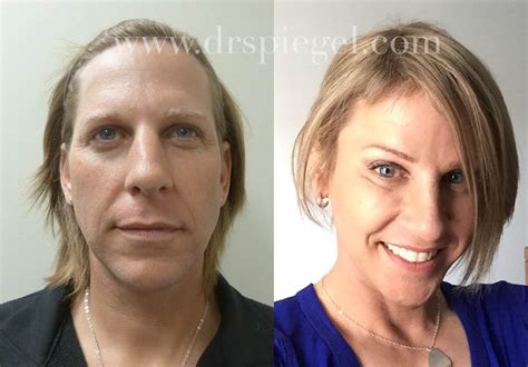 Transgender Surgeries Male To Female Ps Beauty