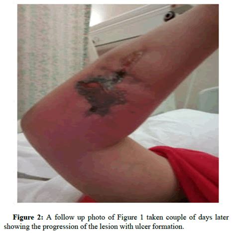 Bullous Pyoderma Gangrenosum Rare Association A Case Report And