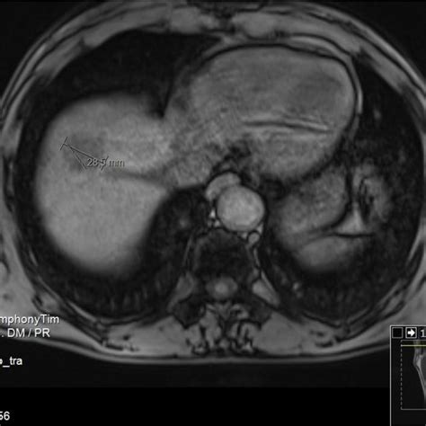 Abdominal Magnetic Resonance Cross Section T1 Weighted Showing A