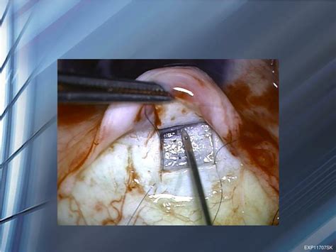 Ppt Ex Press® Device In Clinical Practice New York September 2011