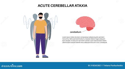 Ataxia Cerebellar Disorder Stock Vector Illustration Of Balance 318265382
