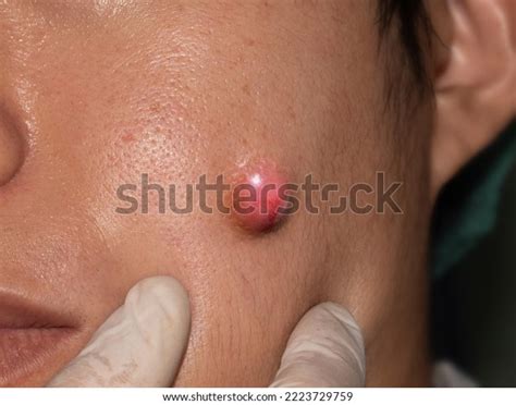 Nodular Acne How To Get Rid Of Cystic Acne According To A