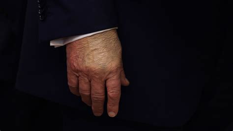 Gnarly Photos Of Trumps Bruised Hand Are A Dark Reminder Of His Age