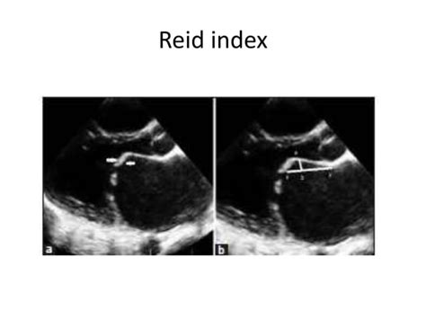 Mitral Stenosis Echocardiography Ppt