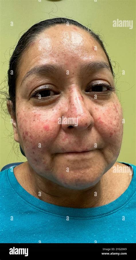 Editorial Use Only Patient With Crest Syndrome Crest Is A Form Of Scleroderma A Chronic