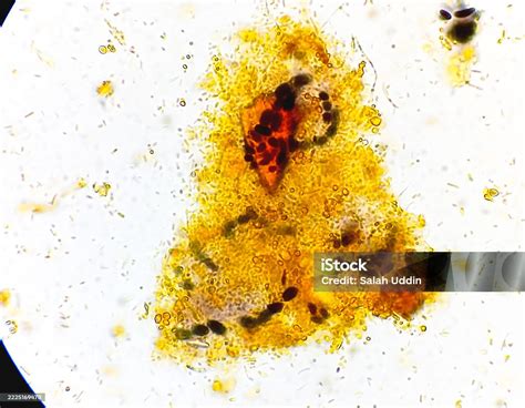 Foto De Microscopic View Of Stool Analysis Showing Starch Granules