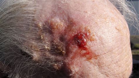 Is Squamous Cell Skin Cancer Dangerous