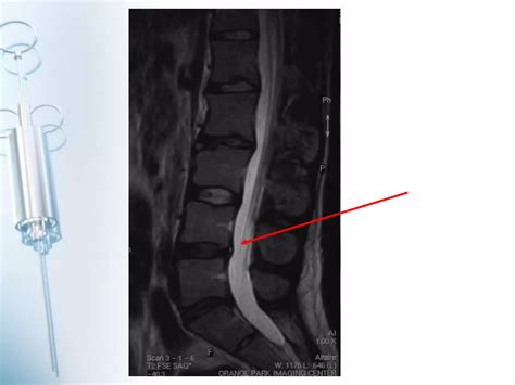 16 30 Andrea Annuloplasty Pptx