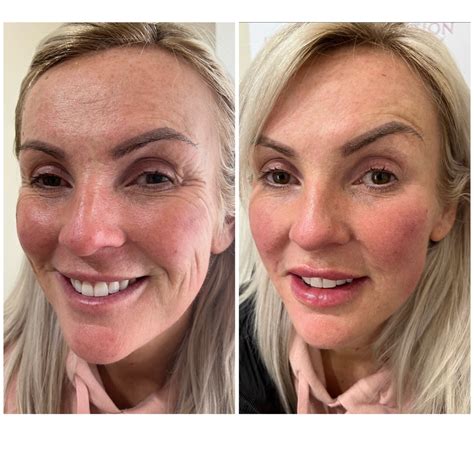 Facial Profiling Injection Queen