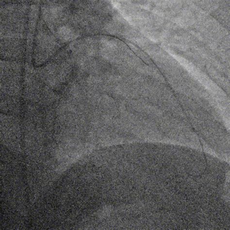 病例荟萃第二十九期｜王欢：telescope™辅助逆向开通cto一例 严道医声网