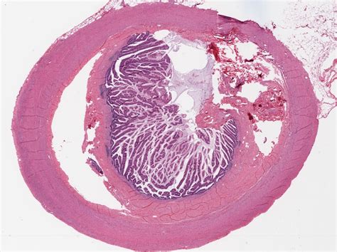 Pathology Outlines Lamn And Hamn