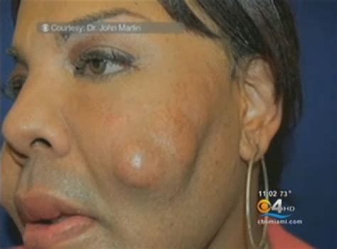 Proof That Injecting Cement Into A Face Is A Bad Idea 4 Pics