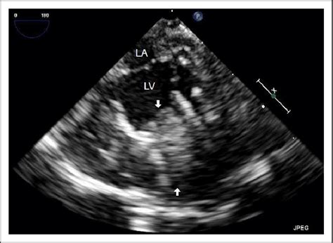 The Tee Image Depicting A Large Thrombus In The Lv Arrows Adherent Download Scientific