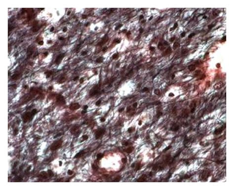 Acute Demyelination In A Person With Amphetamine Abuse Weis 2011