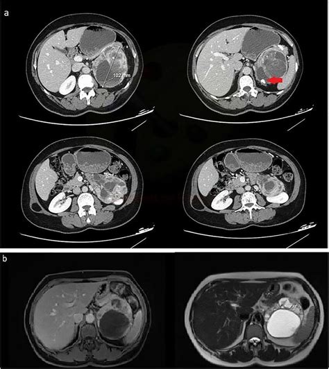 A Ct Scan Shows The Mass The Red Arrow Shows Calcification In The Download Scientific Diagram