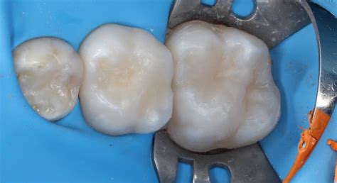 Treatment Of Dentin Caries In Permanent And Deciduous Teeth сases Of