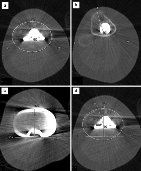 Axial CT Images Of The Right Tibia Showing Internal Rotation Of The Download Scientific Diagram