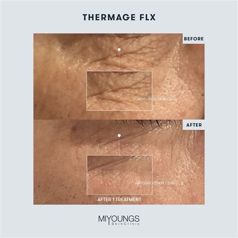 About Thermage Flx Thermage Flx Before And After Pictures Ieyhq
