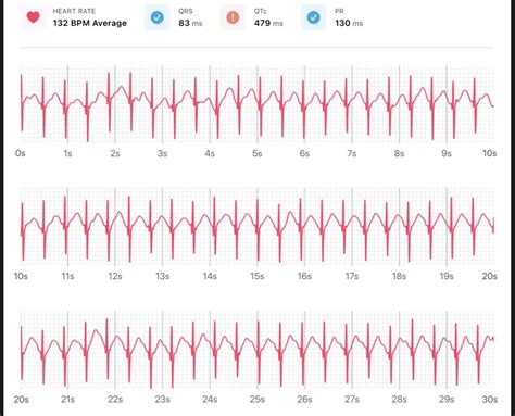 Tried To Calculate My Qt Interval But Couldn T Anyone Able To Help