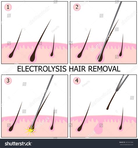 Process Electrolysis Hair Removal Vector De Stock Libre De Regalías