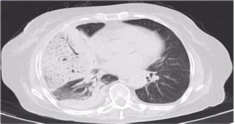 常见肺部 Ct 影像，你能识别出几个？凤凰网健康凤凰网