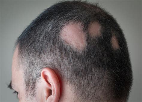 Natural Remedies For Bald Spot