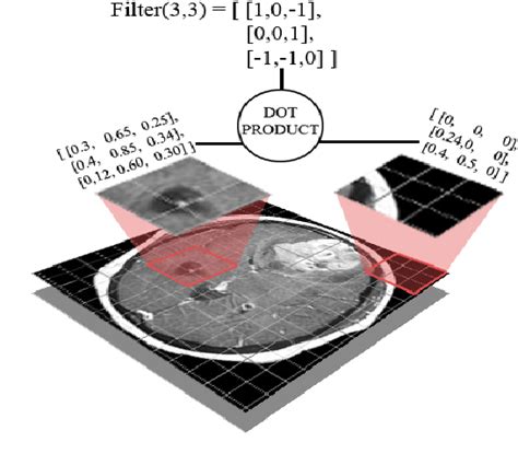 Figure 1 From Brain Tumor Detection Using Artificial Convolutional