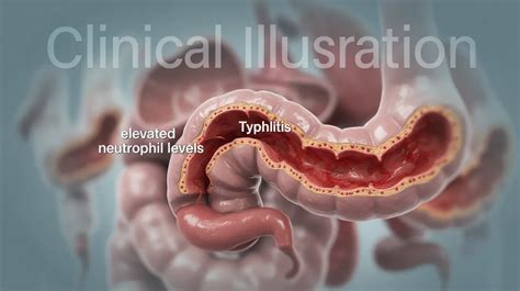 Typhlitis Recovery Time Key Factors And Management Guide