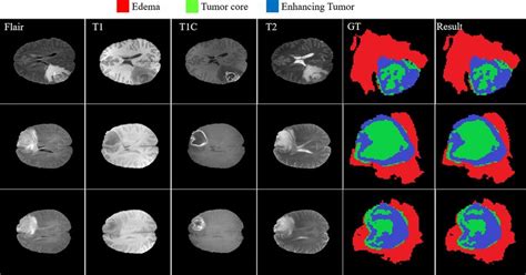 The Results Of Brain Tumor Segmentation Using The Proposed Strategy Download Scientific Diagram