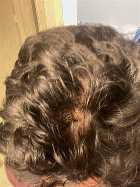 Infection Scalp Picking Stress Rashes Any Hope Of Recovery I Dont Know Where To Start R