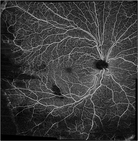Widefield Montage Swept Source Optical Coherence Tomography Angiography