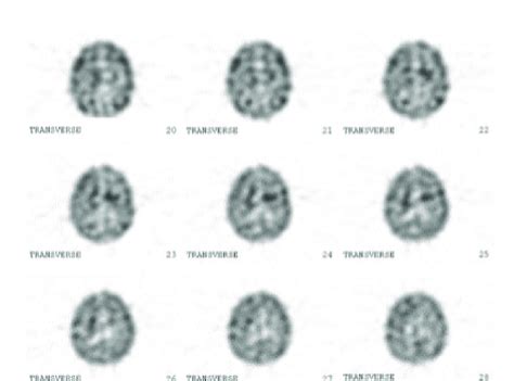 Reconstructed 99m Tc Trodat Images Which Showed Decreased Uptake In The Download Scientific