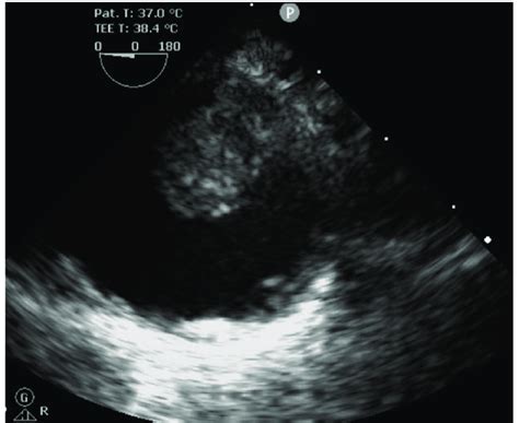 Transthoracic Echocardiography Tte Visualized A Mobile Echo Dense