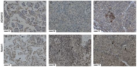 Adam10 Overexpression In Human Non Small Cell Lung Cancer Correlates With Cell Migration And