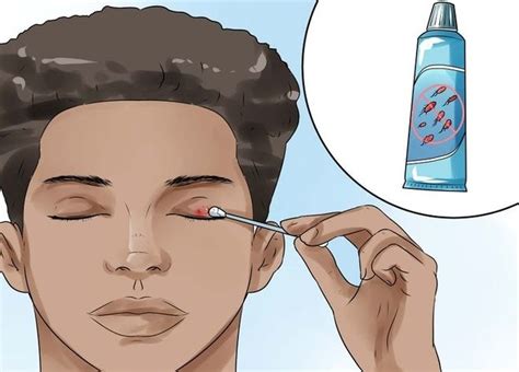 Нүдний өвдгийг гэрийн нөхцөлд хэрхэн эмчлэх вэ