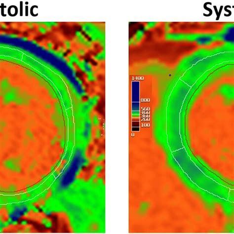 A Graph Of R² Values Plotted In Diastole And Systole Showing Excellent