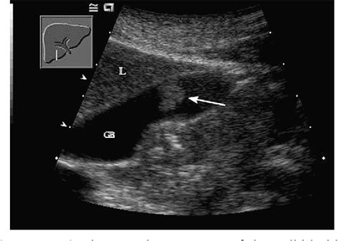 Gallbladder Polyps Ultrasound