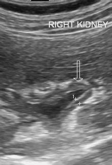Radiopaedia Case Urothelial Thickening Urinary Tract Infection Id