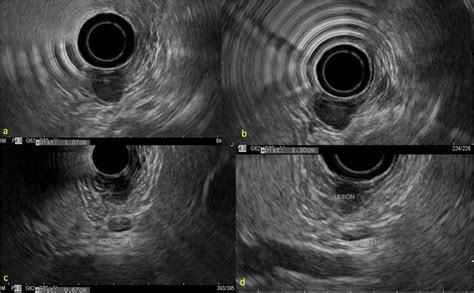 EUS Evaluation A B Submucosal Hypoechogenic Solid Mass Download Scientific Diagram